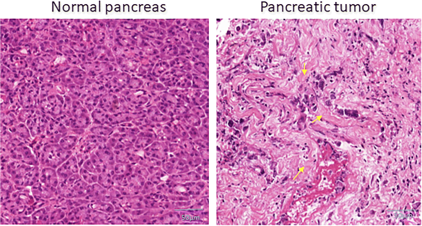 Tumor-stromal crosstalk in pancreatic cancer and tissue fibrosis ...
