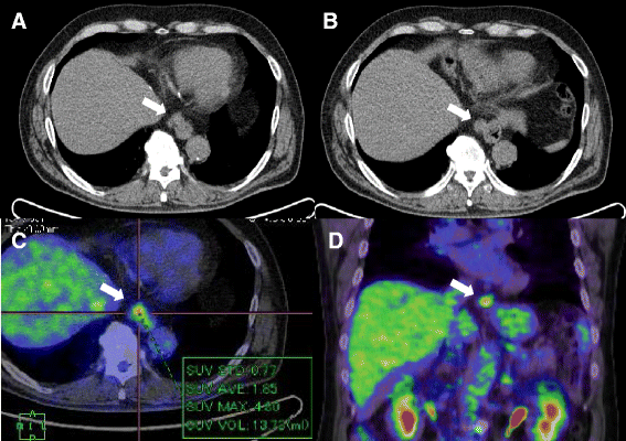 Prone-position thoracoscopic resection of posterior mediastinal lymph ...