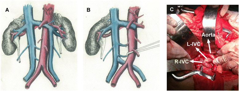 The iatrogenic injury of double vena cava due to misdiagnosis during ...