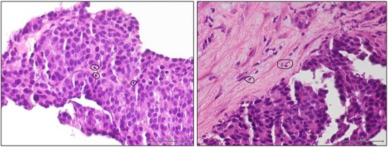 Metronomic temozolomide as second line treatment for metastatic poorly ...