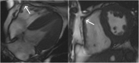 Arrhythmogenic right ventricular cardiomyopathy (ARVC): cardiovascular ...