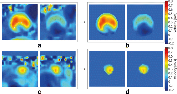 Atlas-based analysis of 4D flow CMR: Automated vessel segmentation and flow quantification ...