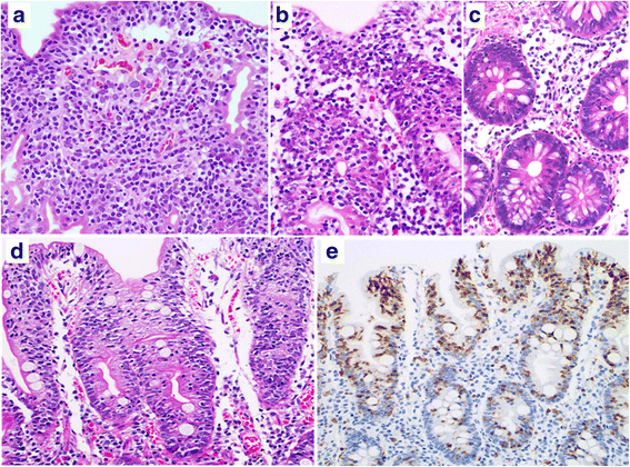 Multiple lesions of gastrointestinal tract invasion by monomorphic ...