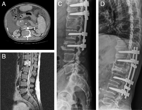 Palliative transpedicular partial corpectomy without anterior vertebral ...