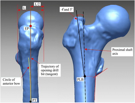 Quantification of cephalomedullary nail fit in the femur using 3D ...