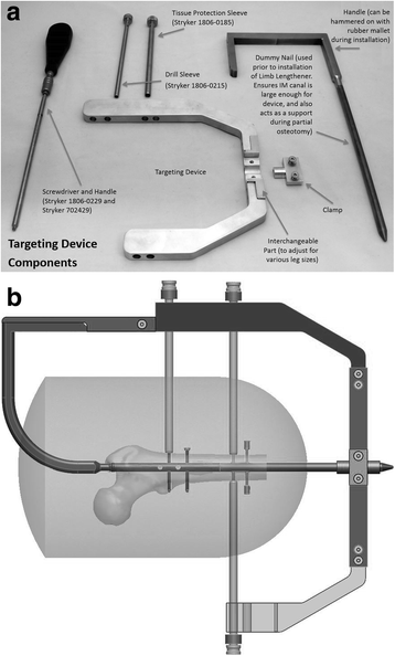 Novel intramedullary device for lengthening transfemoral residual limbs ...