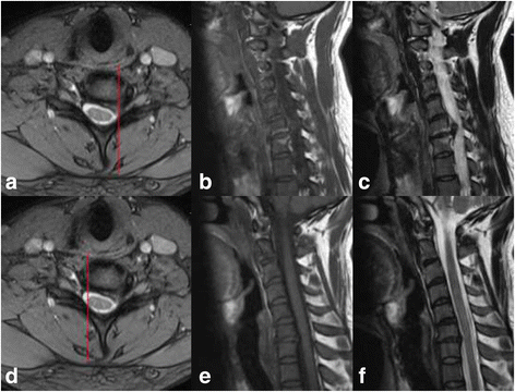 Asymmetrical degenerative marrow (Modic) changes in cervical spine ...