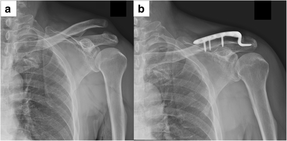 Single coracoclavicular suture fixation with Mersilene tape versus hook ...