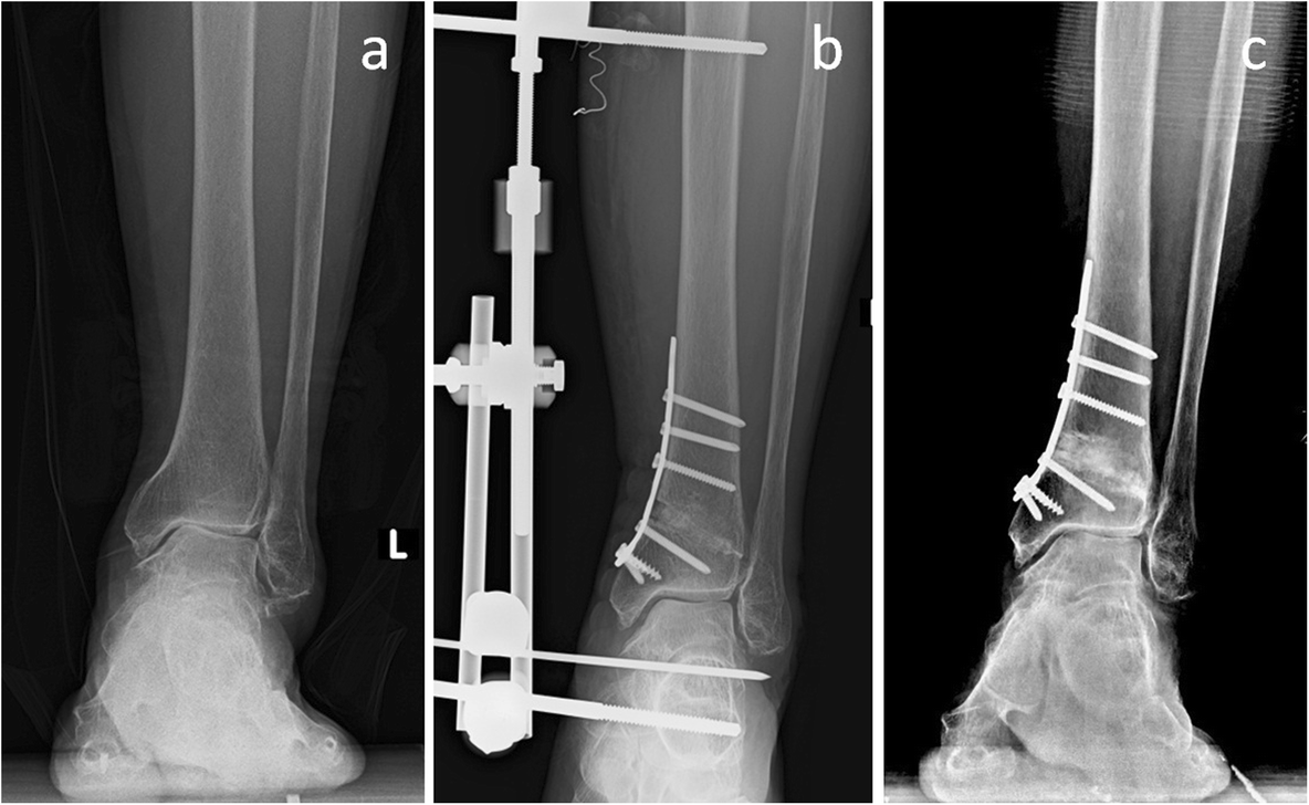 Supramalleolar osteotomy with medial distraction arthroplasty for ankle osteoarthritis with ...