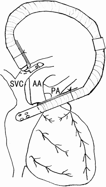 Placement of a modified cannula in the innominate vein for sufficient ...