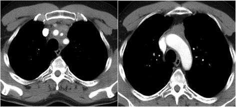 Radical surgical resection of advanced thymoma and thymic carcinoma infiltrating the heart or ...