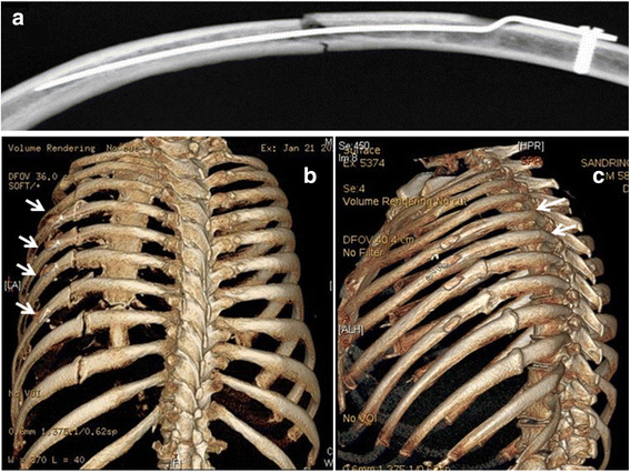 An assessment of outcomes with intramedullary fixation of fractured ...