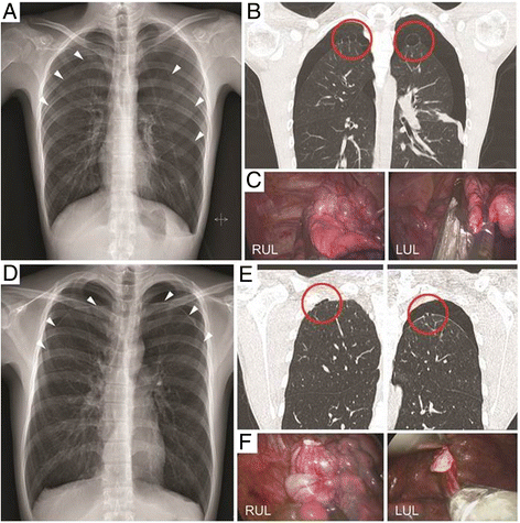 Single-staged uniportal VATS in the supine position for simultaneous ...