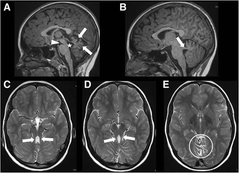 Nosological delineation of congenital ocular motor apraxia type Cogan ...