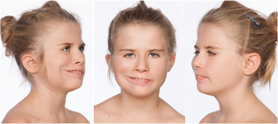 Moebius sequence –a multidisciplinary clinical approach | Orphanet ...