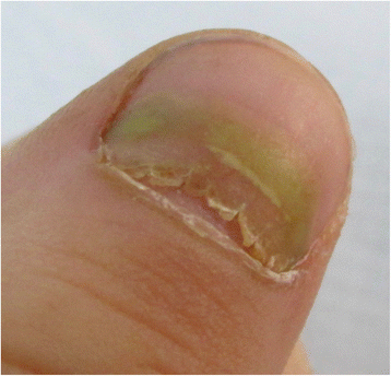Transient yellow discoloration of the nails for differential diagnosis ...