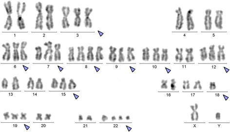 Hyperdiploidy associated with T315I mutation in BCR-ABL kinase domain ...