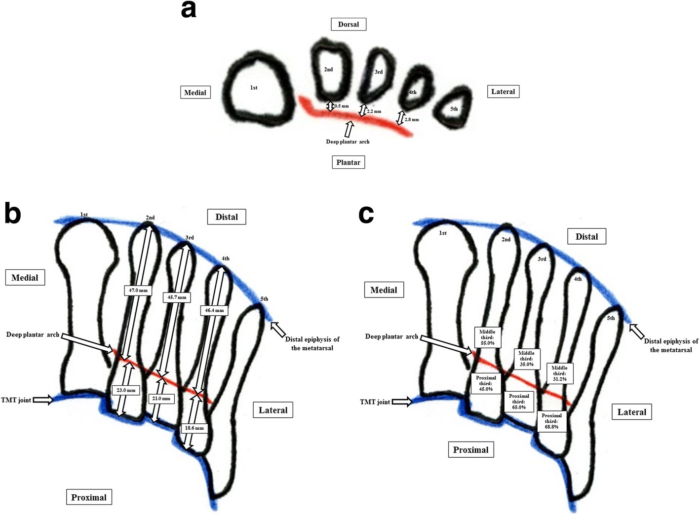 Distances from the deep plantar arch to the lesser metatarsals at risk ...