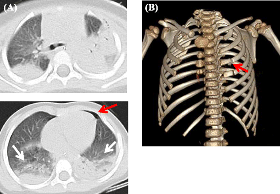 Comparison of two pediatric flail chest cases | Scandinavian Journal of ...