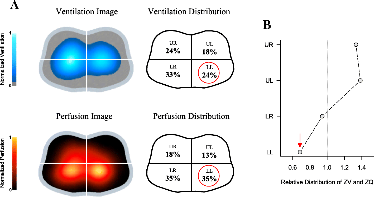 Electrical impedance tomography in acute respiratory distress syndrome ...