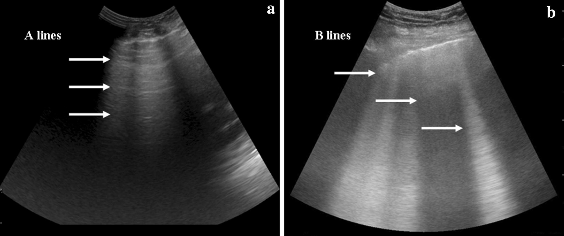 Ultrasound Lung Abnormalities