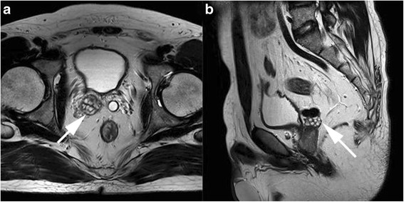 Prostatic urethra malformation associated with retrograde ejaculation ...