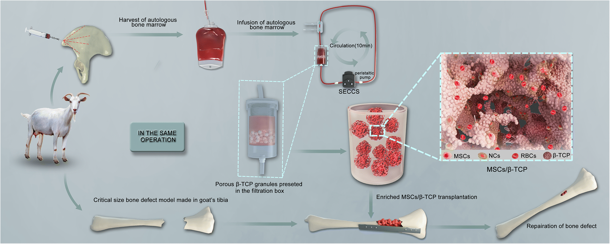 Mesenchymal stem cells and porous β-tricalcium phosphate composites ...