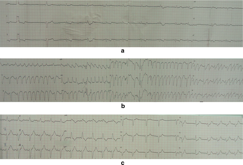Electrocardiographic changes caused by lithium intoxication in an ...