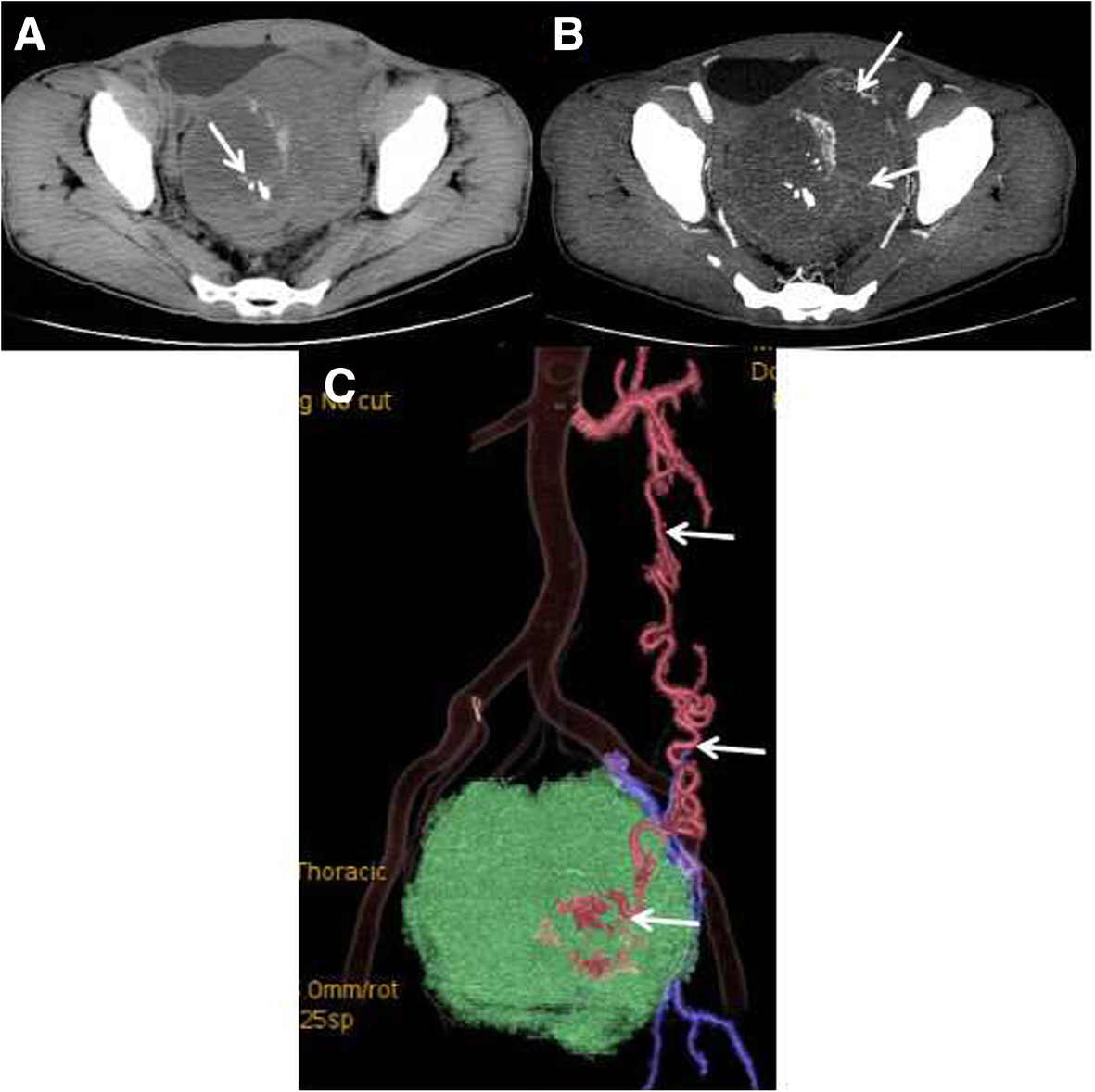 Diagnostic value of multislice spiral computed tomography (CT) combined ...