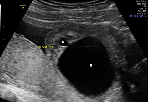 Fetal Lower Urinary Tract Obstruction (LUTO): a practical review for ...