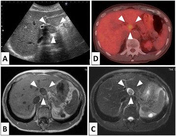 Laparoscopic resection of a retroperitoneal schwannoma located in the ...