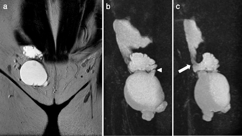 Hydrocele of the canal of Nuck: a case report with magnetic resonance ...