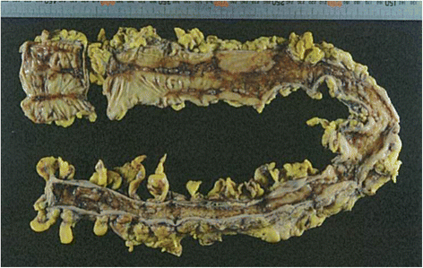 Induction of potentially lethal hypermagnesemia, ischemic colitis, and ...