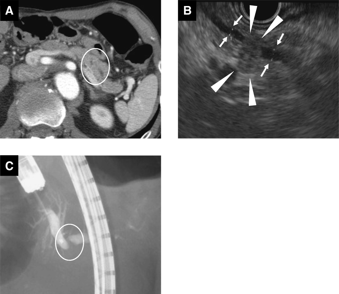 Intrapancreatic recurrence of intraductal tubulopapillary neoplasm ...