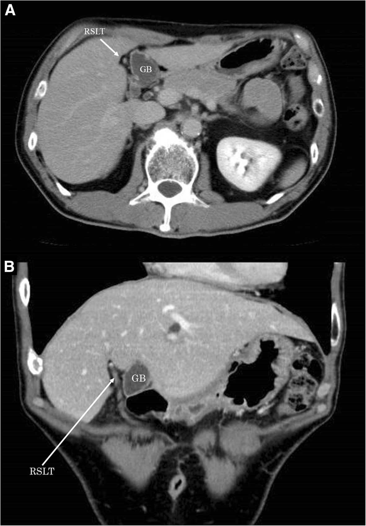 Laparoscopic left lateral sectionectomy for a patient with right-sided ...