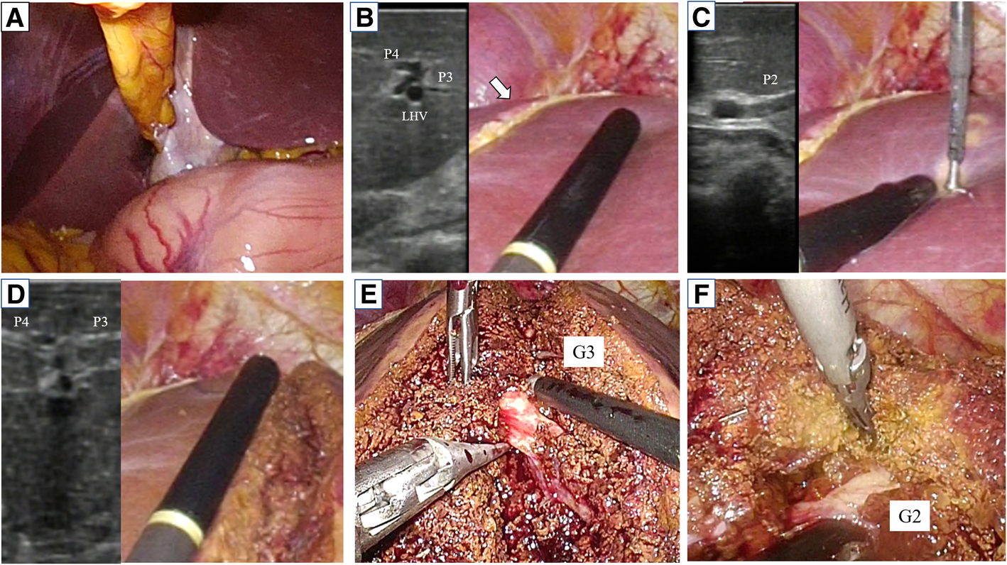 Laparoscopic left lateral sectionectomy for a patient with right-sided ...