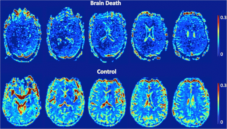 Cerebral perfusion measurement in brain death with intravoxel ...