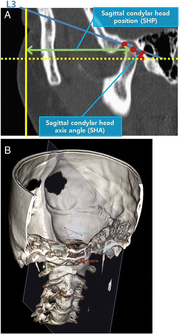 Condylar positioning changes following unilateral sagittal split ramus ...