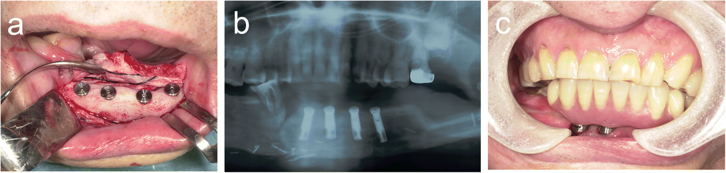 Vertical distraction osteogenesis of a reconstructed mandible with a ...