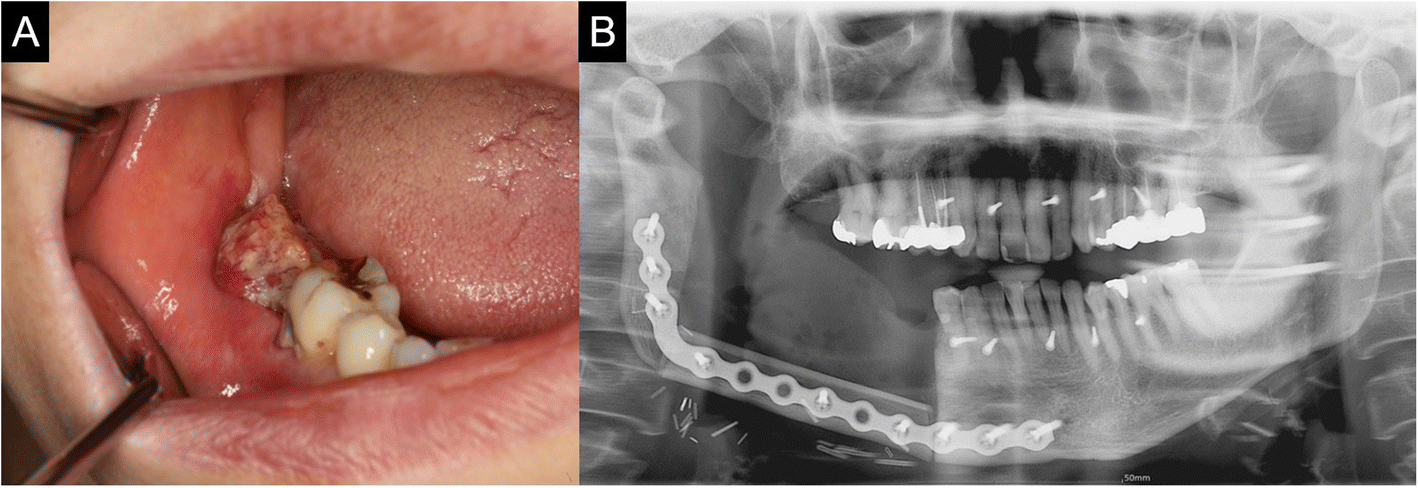 Mandibular reconstruction with a ready-made type and a custom-made type ...