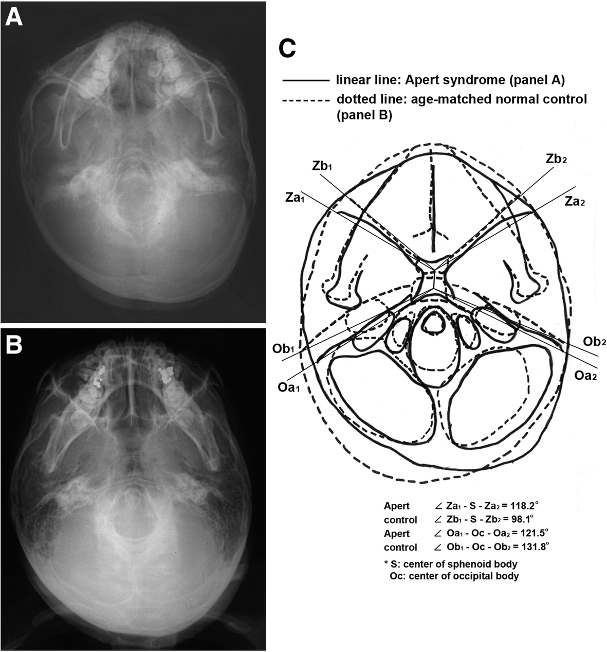 Aberrant growth of the anterior cranial base relevant to severe midface ...