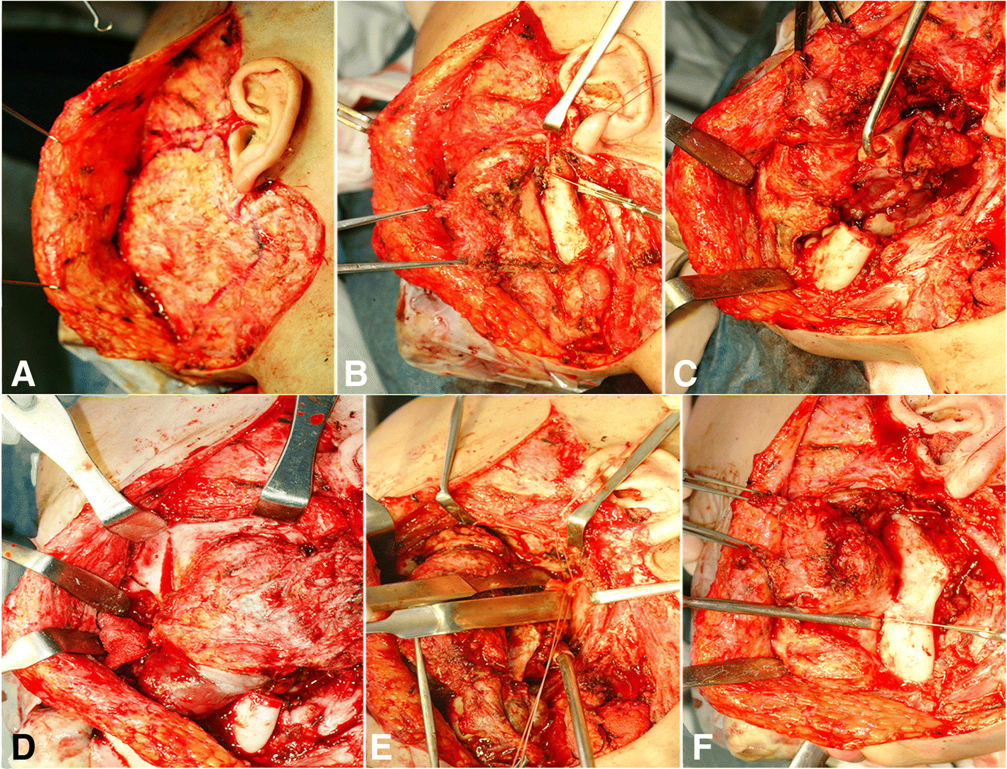Infratemporal fossa approach: the modified zygomatico-transmandibular ...