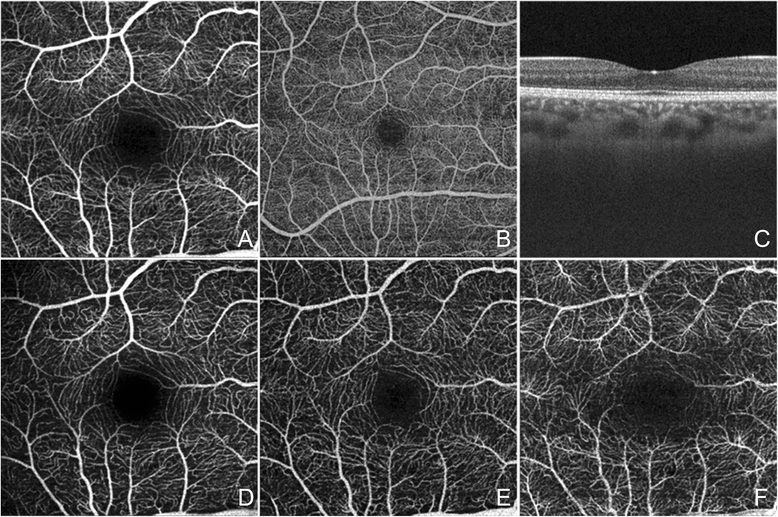 A review of optical coherence tomography angiography (OCTA ...
