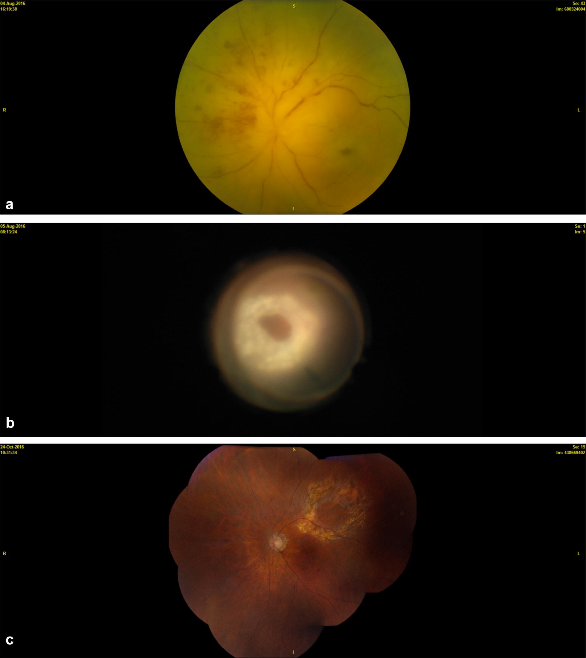The diagnosis and treatment of primary vitreoretinal lymphoma: a review ...