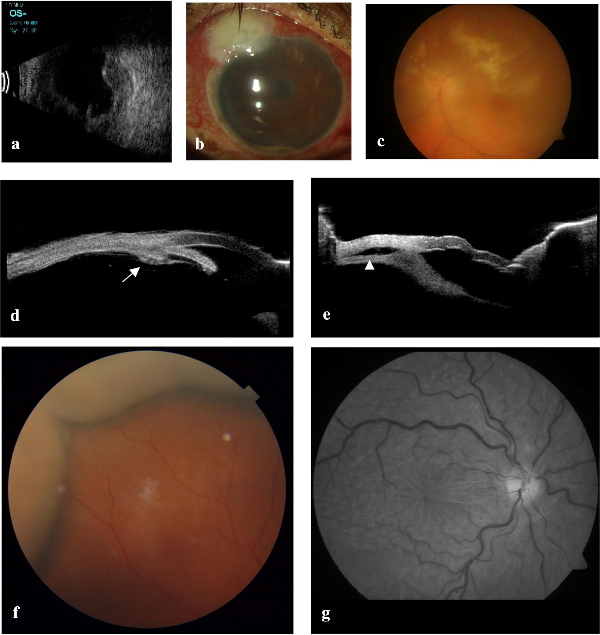 Retina and glaucoma: surgical complications | International Journal of ...