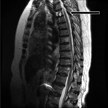 Spinal cord infarction following epidural and general anesthesia: a ...