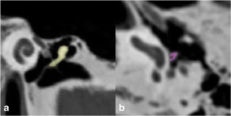 Surgical reconstruction of the ossicular chain with custom 3D printed ...