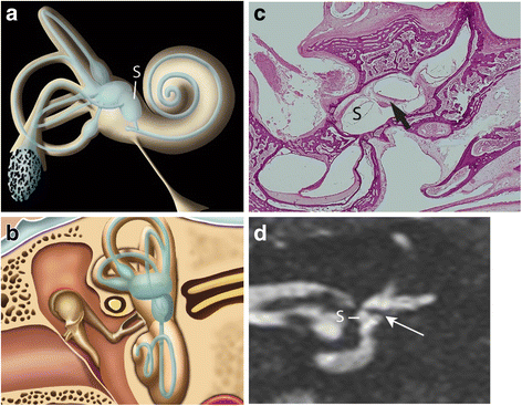 Imaging of the saccule for the diagnosis of endolymphatic hydrops in ...