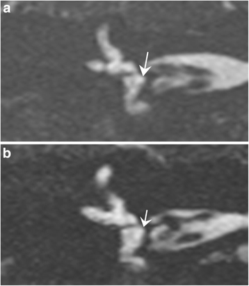 Imaging of the saccule for the diagnosis of endolymphatic hydrops in ...