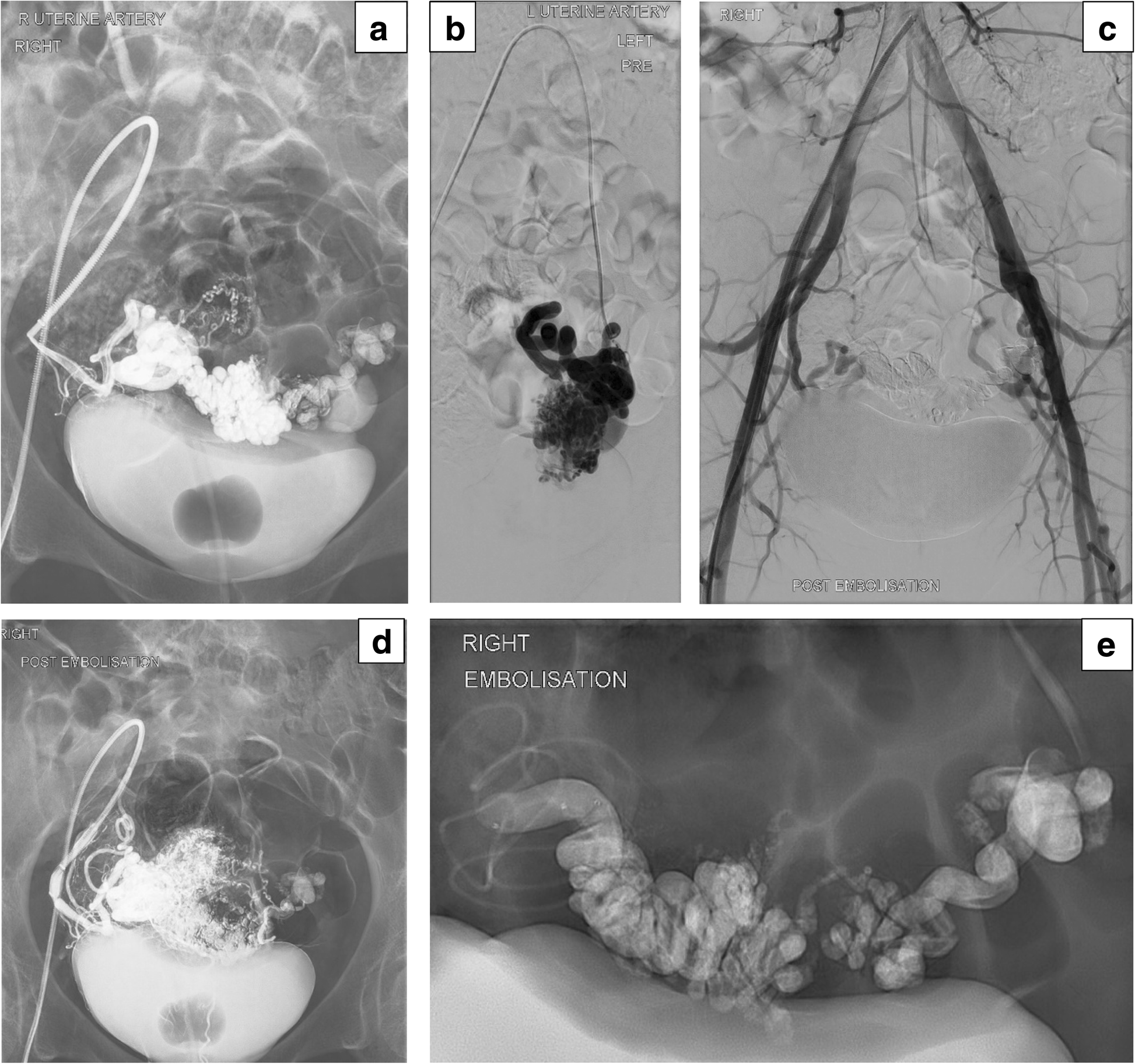 Precipitating hydrophobic injectable liquid (PHIL) embolic for the ...